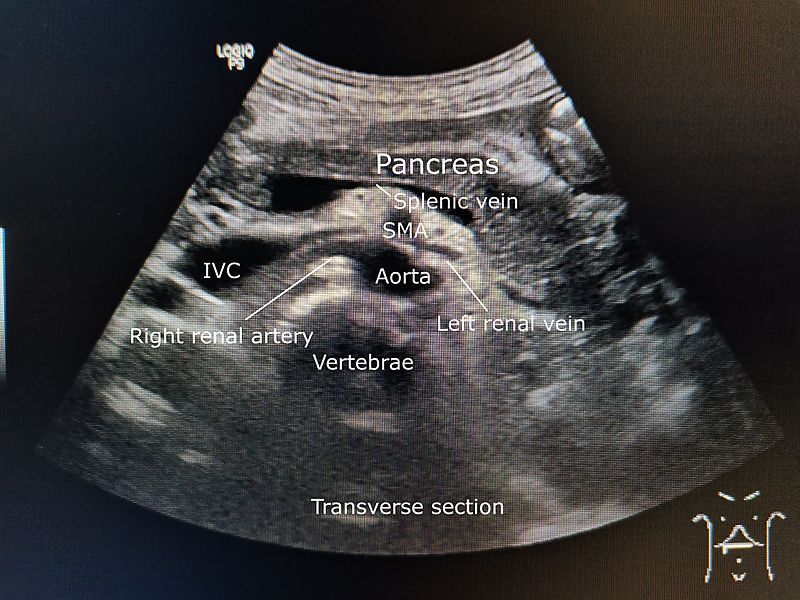 Image: Axial section of the epigastric region showing pancreas, splenic ...
