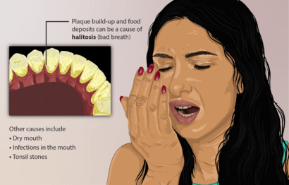 Bad breath Facts for Kids